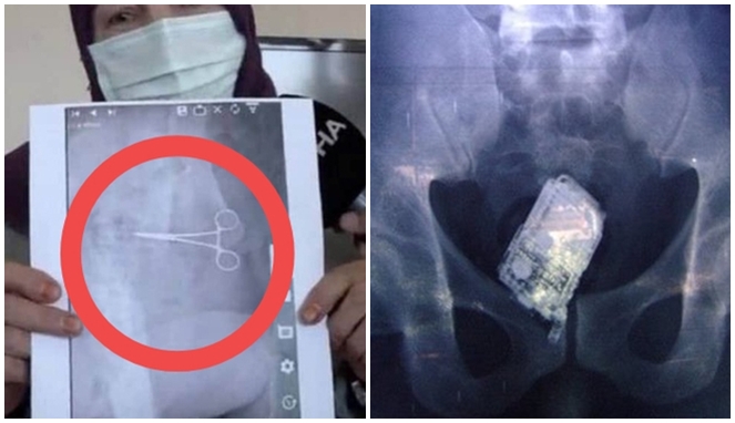 Bikin Ngeri! Benda Asing Ini Tertangkap Rontgen Masuk ke dalam Tubuh ...