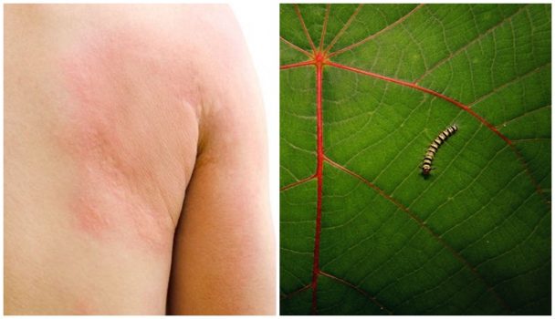 Jangan Digaruk, Ini 5 Hal yang Harus Kamu Lakukan Saat Gatal Terkena ...