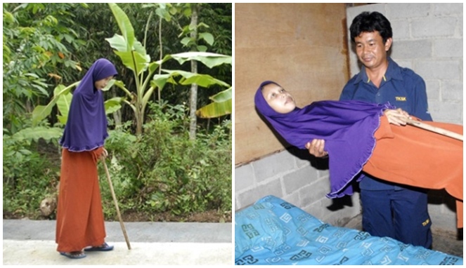 Kisah Sulami Pengidap Sindrom 'Manusia Kayu' yang Tak Bisa Menggerakkan ...